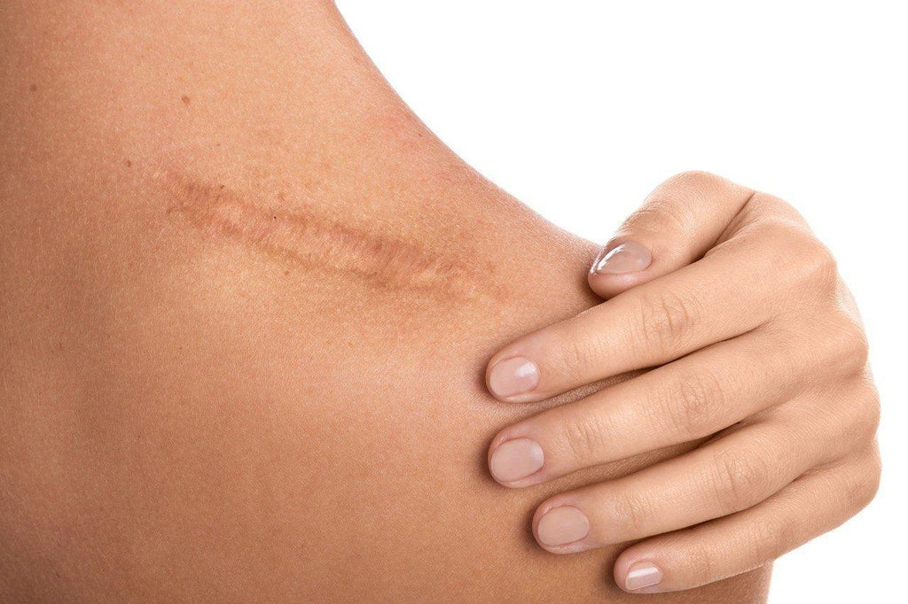 Is It Normal To Have Scars Is It Normal To Have Scars